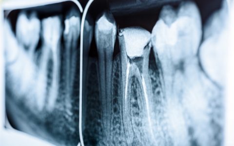 Understanding Radicular Cysts & What To Do About Them